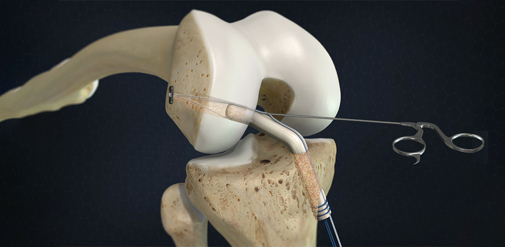 ACL Surgeon in Chandigarh | Dr Siddharth Aggarwal